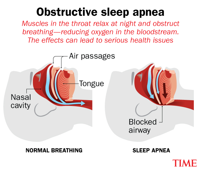 What to Do If You Have Sleep Apnea - your health manual
